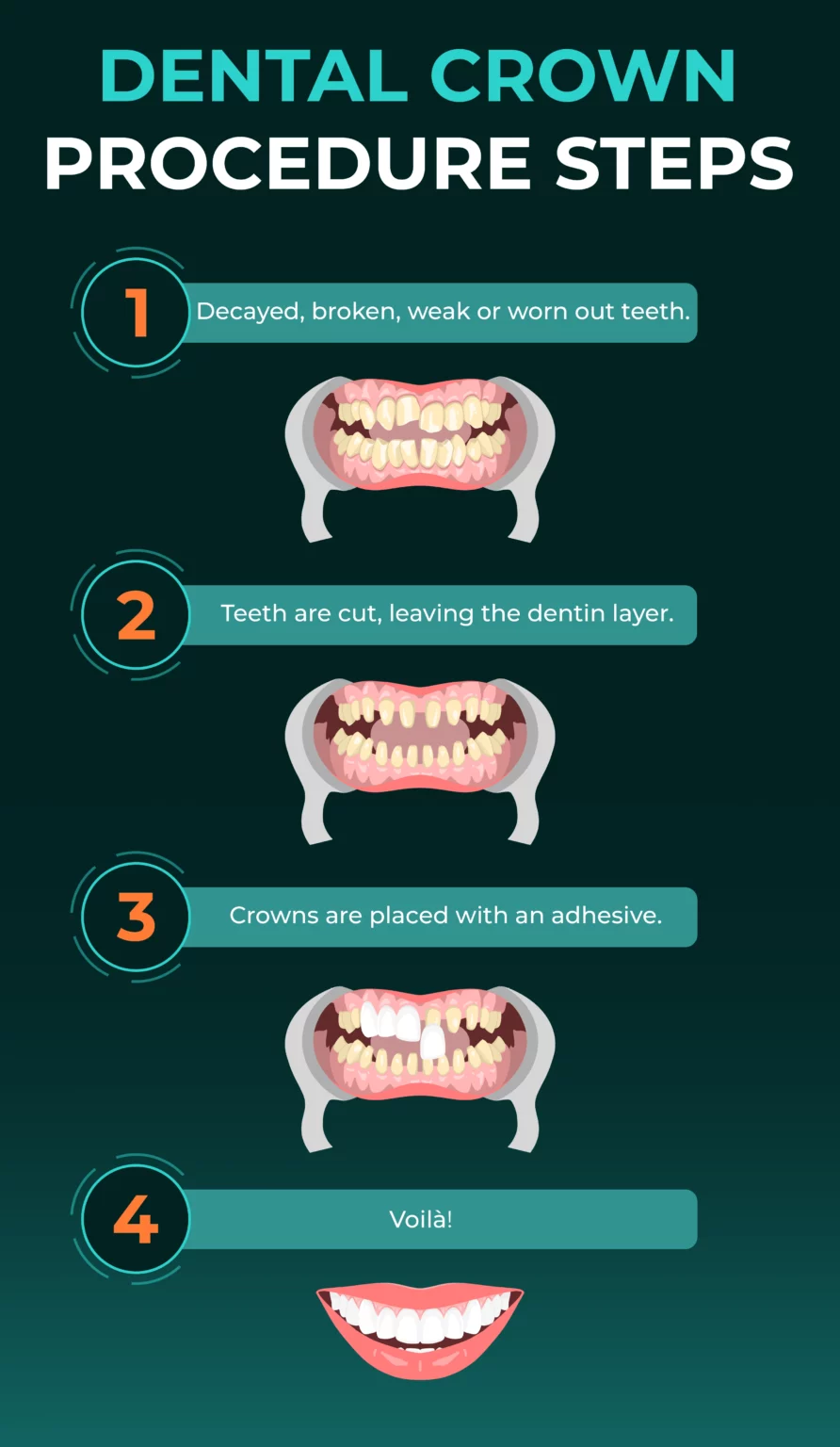 Dental Crown Procedure: Prep, Sessions, and Final Result - Dentfix