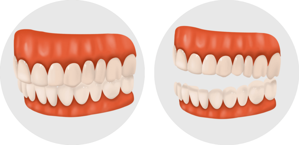 My bite is off after crown, is it normal? - Dentfix