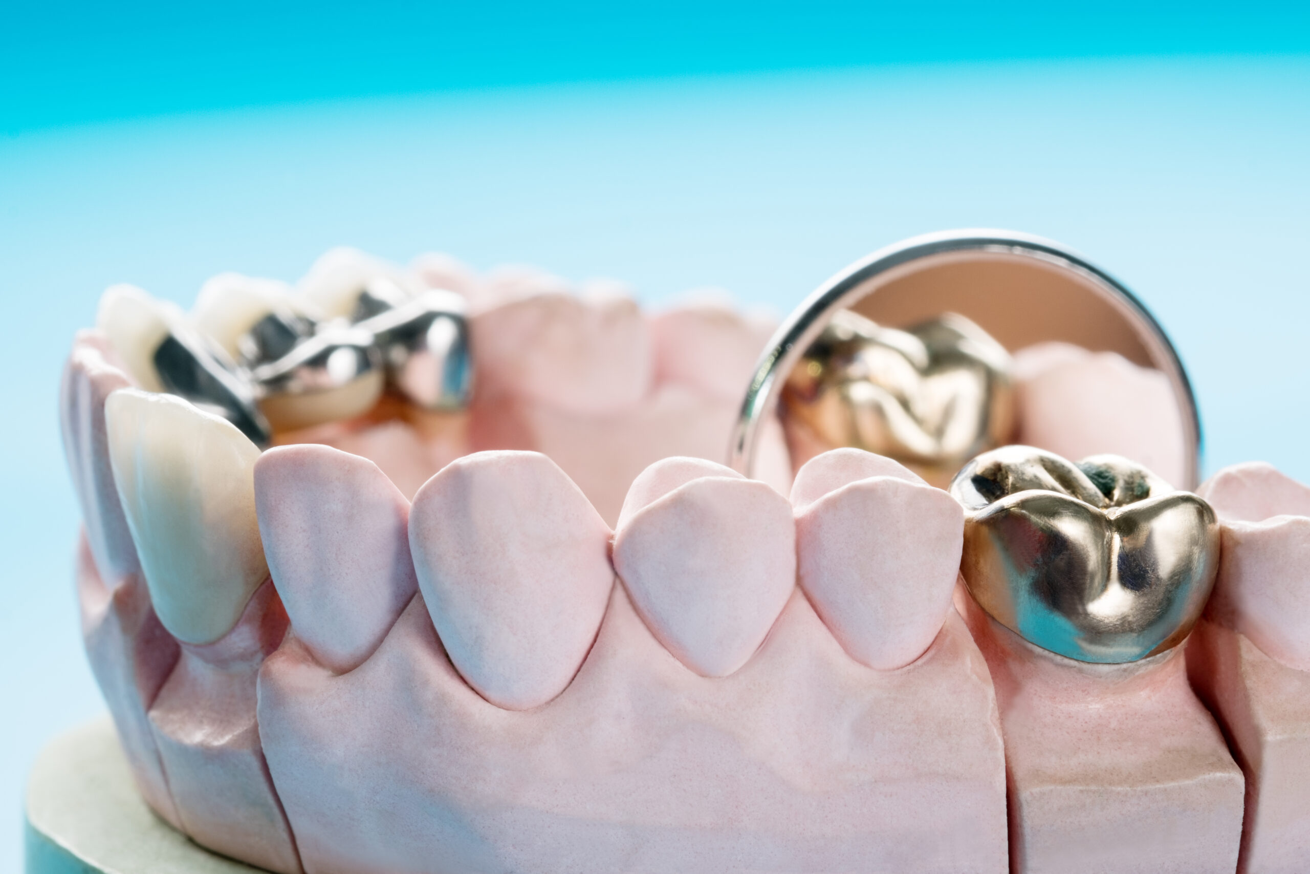 Can you use Super Glue on tooth and how to remove it if you did?