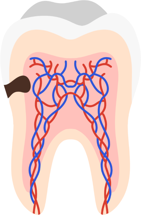 How Do Dentists Fix Tooth Decay? - Dentfix