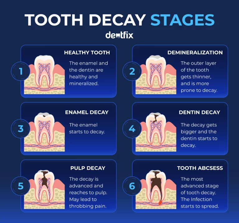 How Do Dentists Fix Tooth Decay? - Dentfix