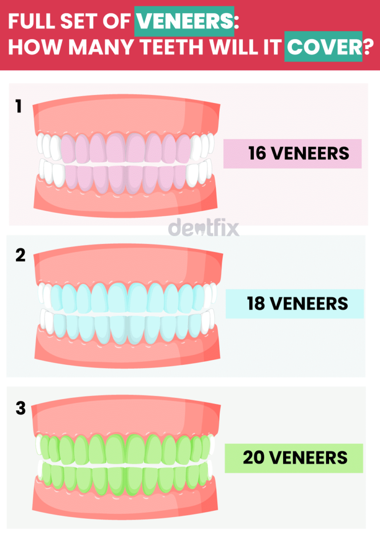 Full set of veneers in Turkey: costs, numbers and benefits